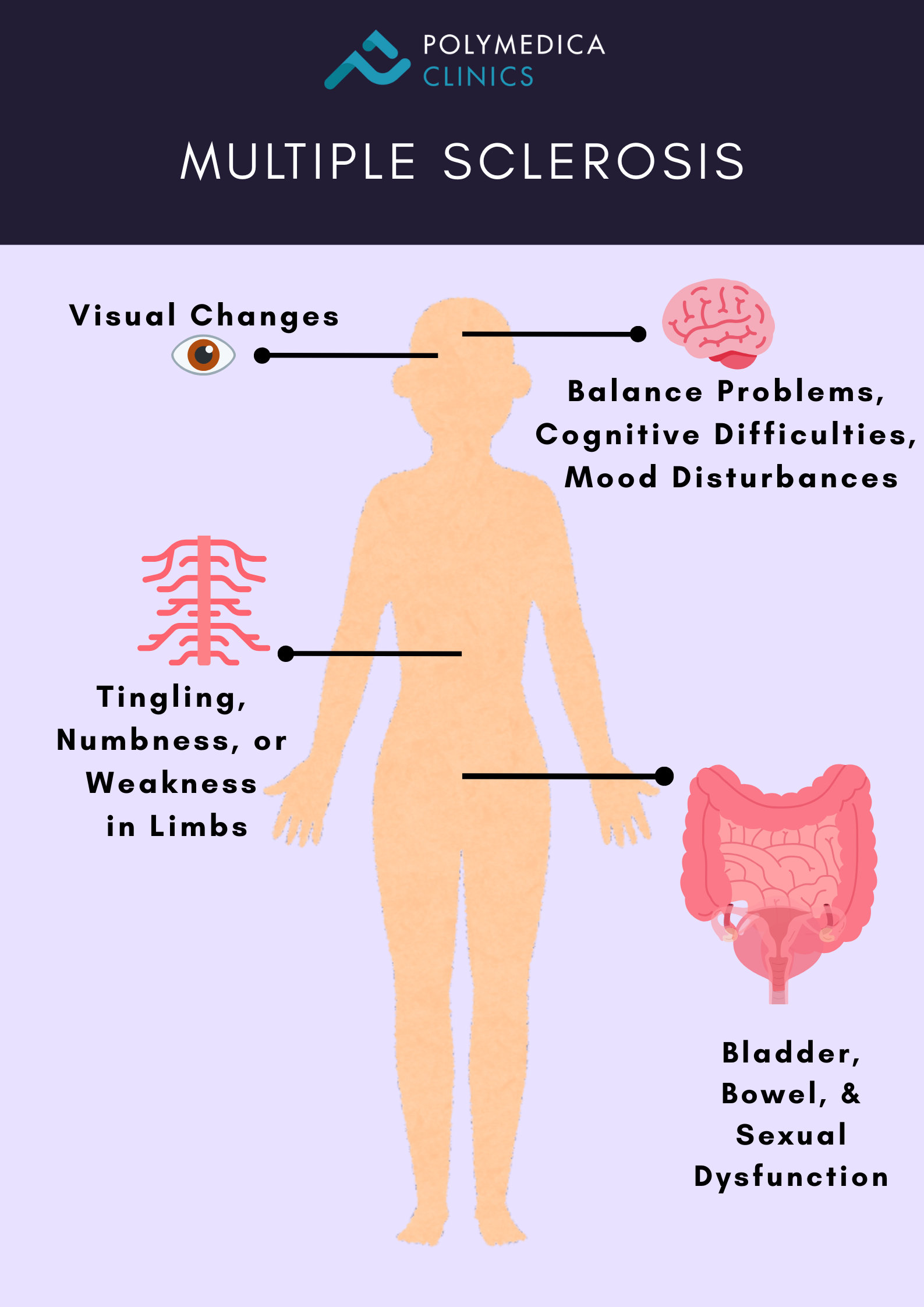 Understanding Multiple Sclerosis