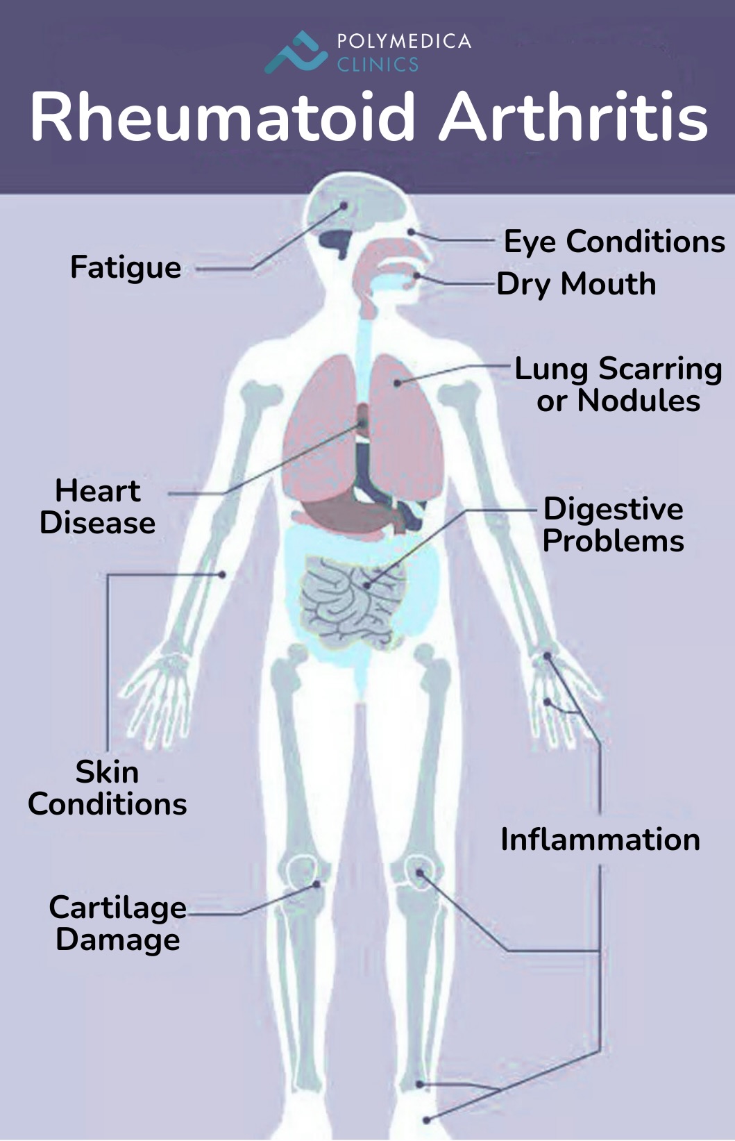 Understanding Rheumatoid Arthritis